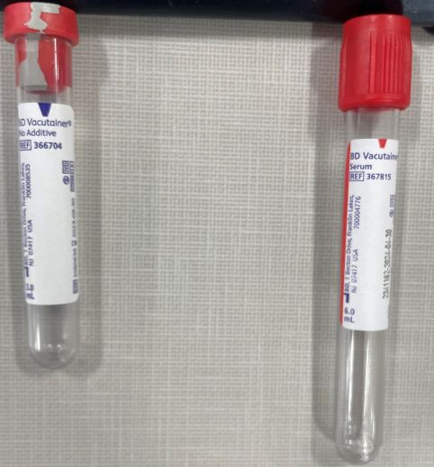 SYNOVASURE PJI - Alpha Defensin PJI - Bronson Laboratory Services